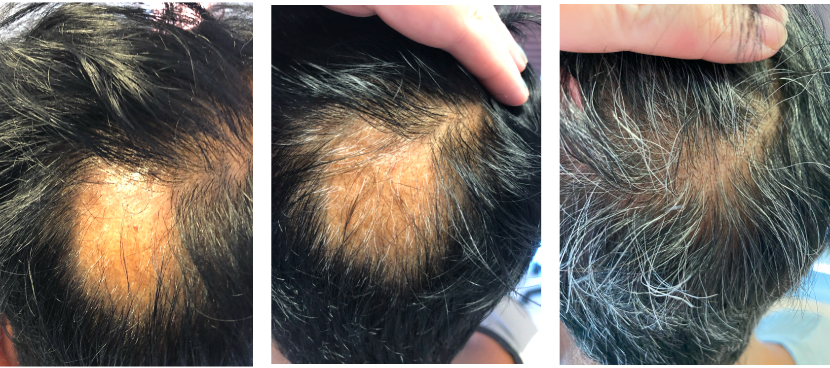 Trichotin Hair Regenesis | Nu Youth Medical Aesthetics